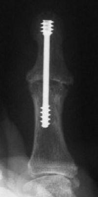 Arthritis Rheumatoid Thumb IP Fusion With A Herbert Screw Arthritis Rheumatoid Thumb IP Fusion With A Herbert Screw